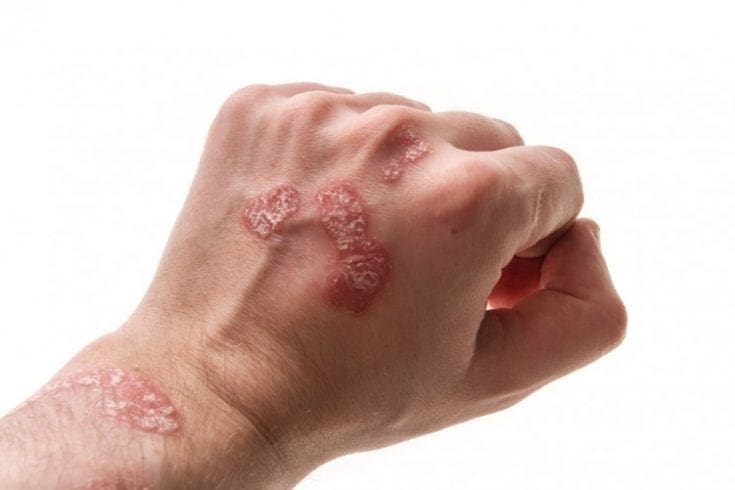 Understanding Psoriasis And Its Various Forms - The Best Of Health
