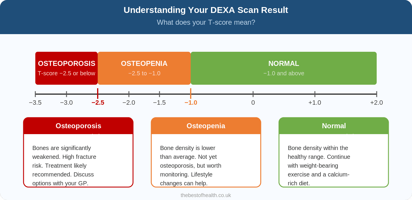 Compare the Cost of a DEXA Bone Density Scan in the UK (2026) - The ...